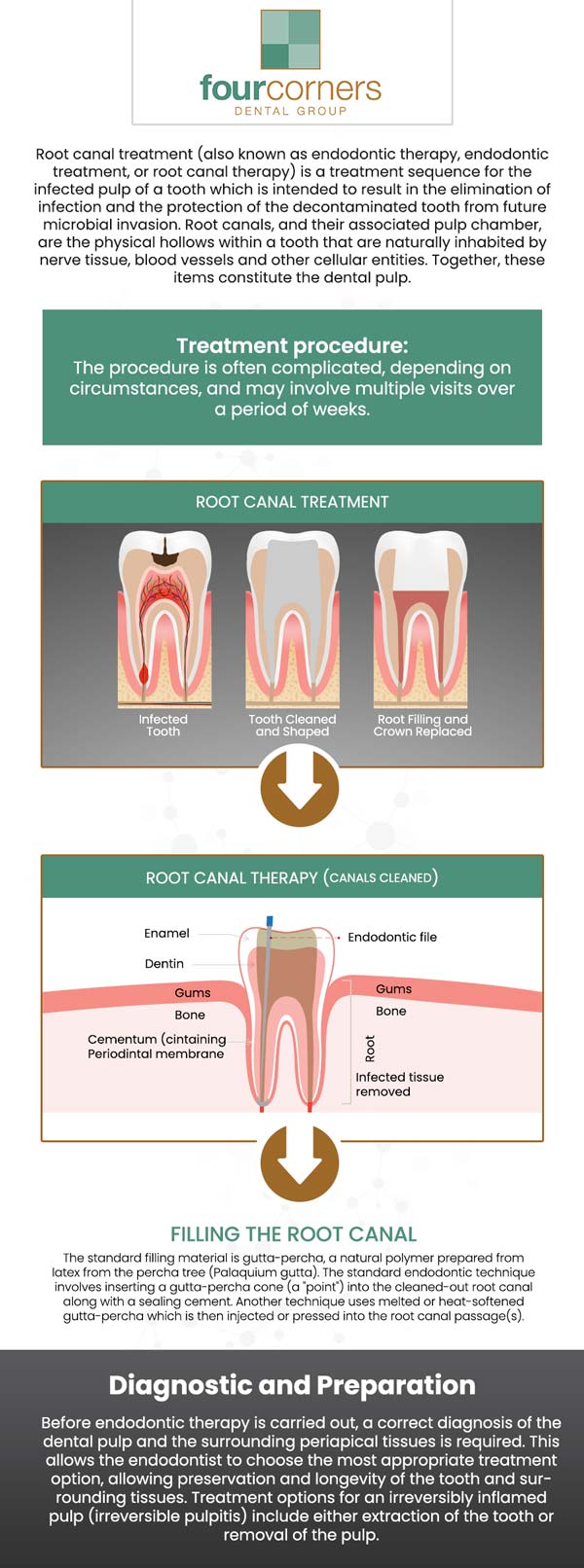 Root Canal Treatment Near Me in Anchorage and Wasilla, AK
