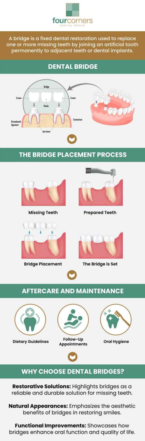 Dental Bridge Procedure: What to Expect | Anchorage, AK
